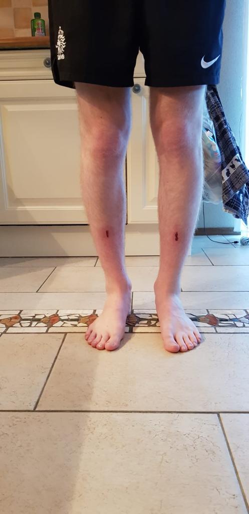 Scheenbeenpijn bij het skiën – Skischoenopmaat.nl